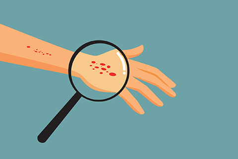 Acute generalized exanthematous pustulosis with systemic involvement ...