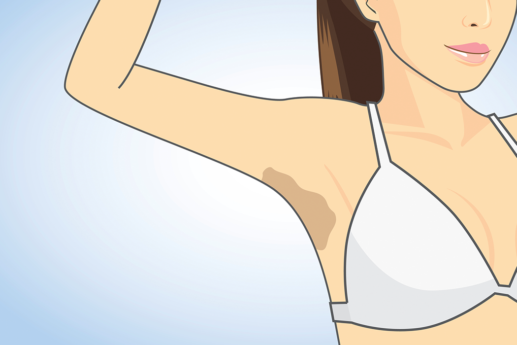 Lichen planus pigmentosus inversus: a rare clinical variant - American Osteopathic Association